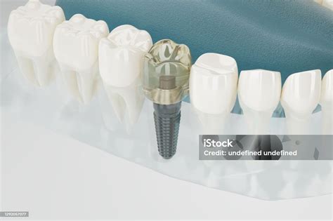 투명 치과 임플란트의 구성 요소를 닫습니다 3d 렌더링 부축하기에 대한 스톡 사진 및 기타 이미지 부축하기 틀니 X 레이 Istock
