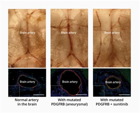 First Drug Treatment For Aneur [image] Eurekalert Science News Releases