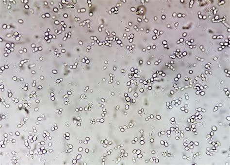 400 Pyelonephritis Pictures