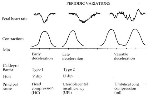 Fetal Heart Rate Monitoring Fhr Birth Injury Lawyers