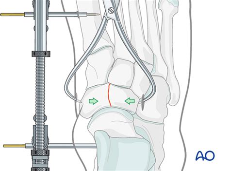 Lag Screw Fixation For Complete Articular Navicular Fracture