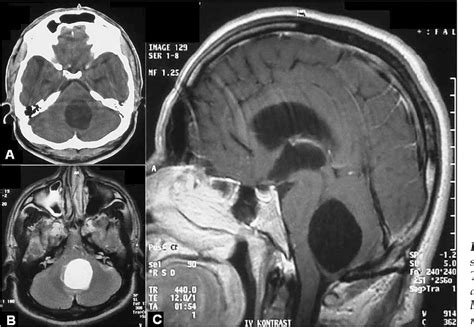 Arachnoid Cyst Posterior Fossa