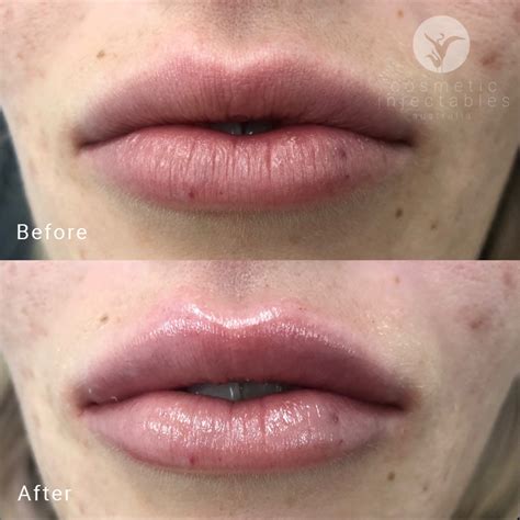 Dermal Fillers Brisbane Gold Coast And Darwin