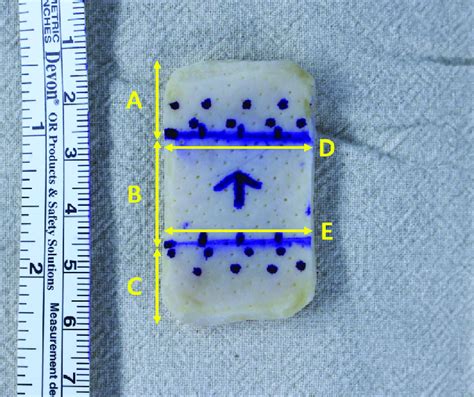 Acellular Dermal Matrix Allograft Preparation Based On Arthroscopic Download Scientific Diagram
