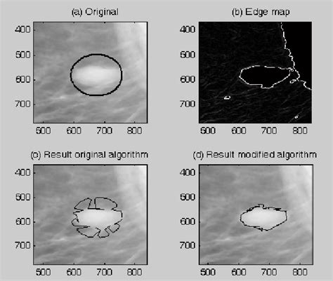 Figure 2 From Analysis Of Mammogram Using Self Organizing Neural Networks Based On Spatial