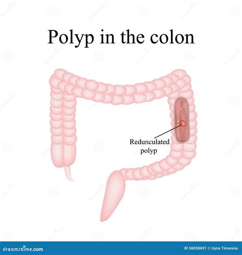 Polyp In The Intestine Polyp In The Colon Vector Stock Vector Illustration Of Digestive