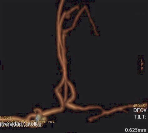 12 The Azygos Anterior Cerebral Artery Radiology Key