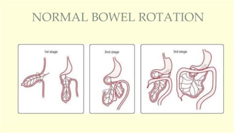 Foetal Gut Development And Congenital Malformation Flashcards Quizlet