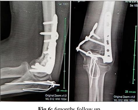 Figure 1 From Functional Outcome Of Distal Humerus Fracture In Adults Treated With Bicolumnar