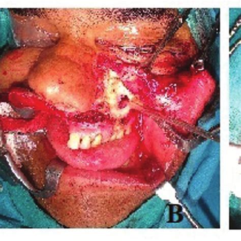 Showing Surgical Steps Performed In Doing Left Partial Infrastructure Download Scientific