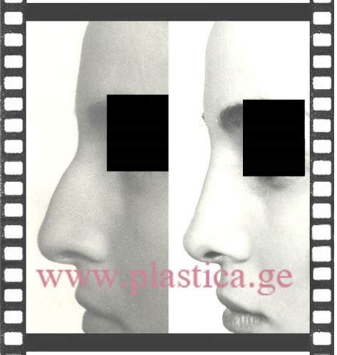 რინოპლასტიკა ცხვირის პლასტიკა