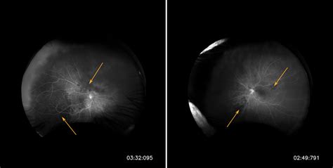 Optos Fluorescein Angiography Fa Imaging Demonstrating Delayed Download Scientific Diagram