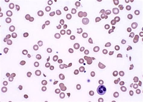 November 2015 Case Of The Month Question Uc Davis Department Of Pathology