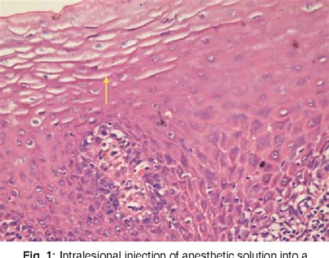 Figure 1 From Biopsy And Tissue Processing Artifacts In Oral Mucosal