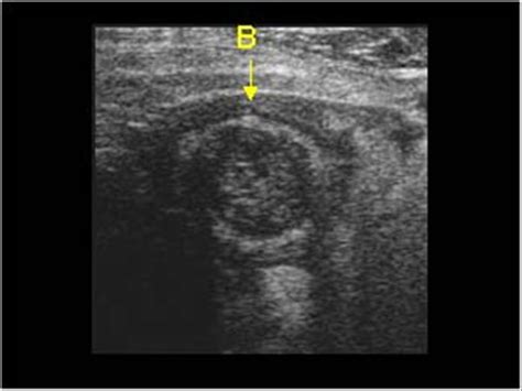 Abdomen And Retroperitoneum 15 Appendix Case 152 Uncomplicated