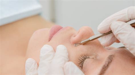 Blackhead Removal