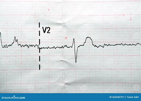 Ecg Electrocardiograph Paper That Shows Normal Sinus Rhythm Nsr With