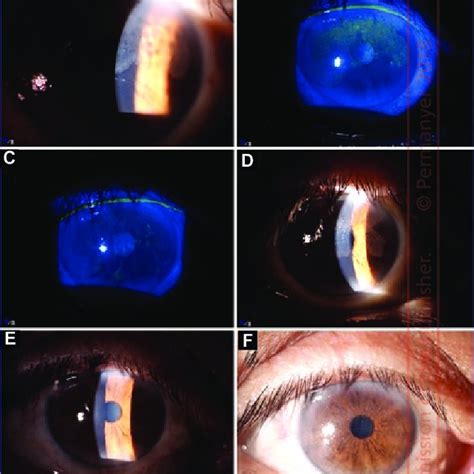 Corneal Epithelium Scraping Sample The Arrow Points At The Basal Third