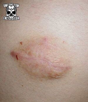 Nipple Removal BME Encyclopedia