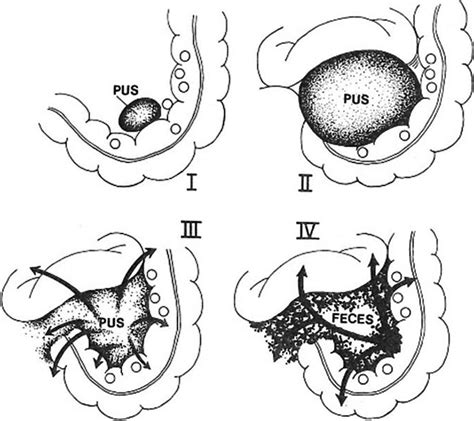 Management Of Complicated Diverticulitis Of The Colon Tochigi 2018 Annals Of