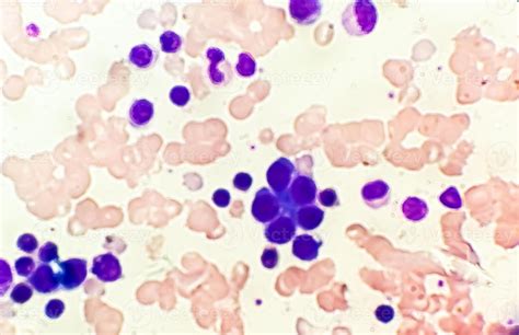 Photomicrograph Bone Marrow Study Megakaryocytic Hyperplasia 43292143