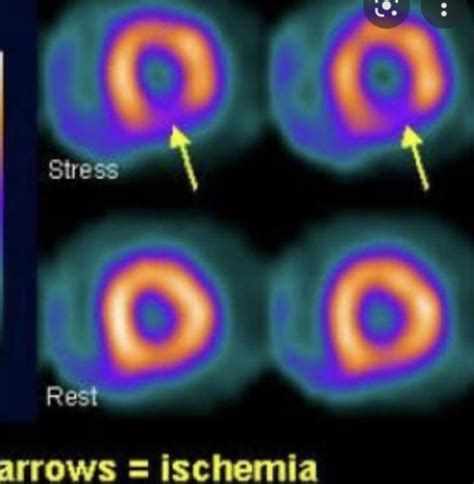 Stress Testing Flashcards Quizlet