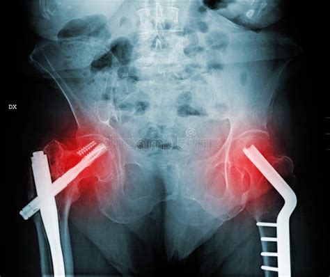 X Ray Of The Pelvis And Hips With Two Different Femoral Prostheses Of An Elderly Woman With Red