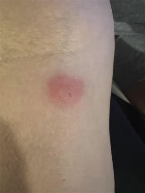 What Kind Of Bite Is This Spider Scorpion Sting Rhawaii