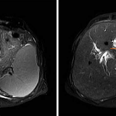 Pathological Images A Intrahepatic Bile Duct Papilloma Ipnb S Download Scientific Diagram