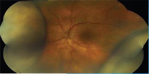 Choroidal Abnormalities Flashcards Quizlet