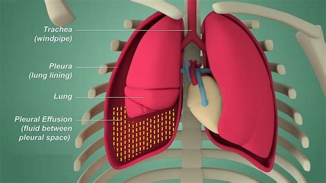 Pleural Effusion Definition Pleural Effusion Brezelbruder