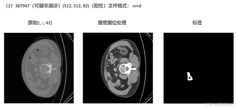 读取nrrd和dcm文件格式医学图片可视化与预处理nrrd文件 Csdn博客