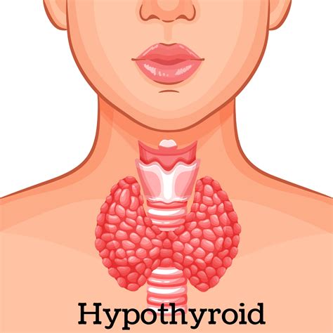 Understanding Hypothyroidism What You Need To Know Contemporary Alternative Care