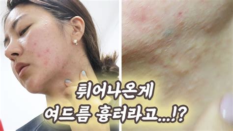 저의 켈로이드성 여드름 흉터 소개해요앞으로의 치료 계획😢 Youtube