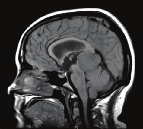 Sagittal Brain Mri