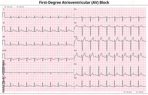 Ecg First Degree Atrioventricular Block 1st Degree Av Block 12 Lead Ecg Common Case 6 Sec