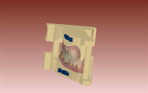 Stl File Digital Quadrant Model With Orbix W Pins Articulator Interfaces 🥼 Obj And 3mf ・3d