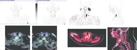 A 58yearold Male With Suspected Primary Hyperparathyroidism Underwent