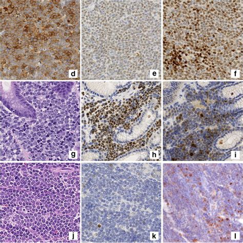 Landscape Of Combined Genomic Copy Number Gains Dark Blue Losses Download Scientific Diagram