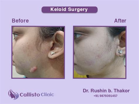 Keloid Surgery Callisto Clinic