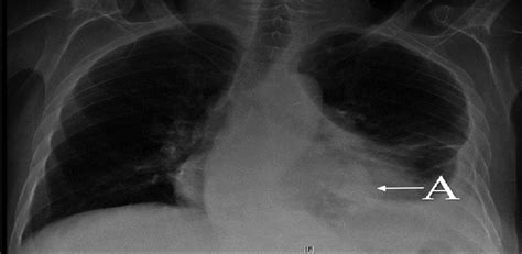 Caseous Mitral Annular Calcification Mimicking A Lung Tumor