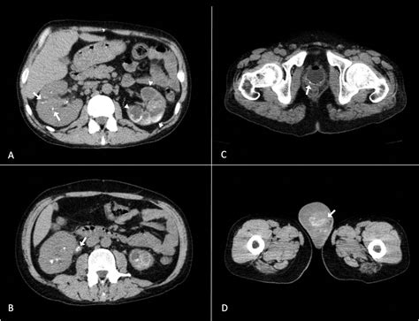 Extensive Urogenital Calcification And Hypercalcemia Secondary To