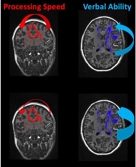 Cognitive Studies Of Twice Exceptionality Have Identified A Common