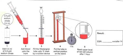 Clotting Time Test Principle Procedure By Capillary Method