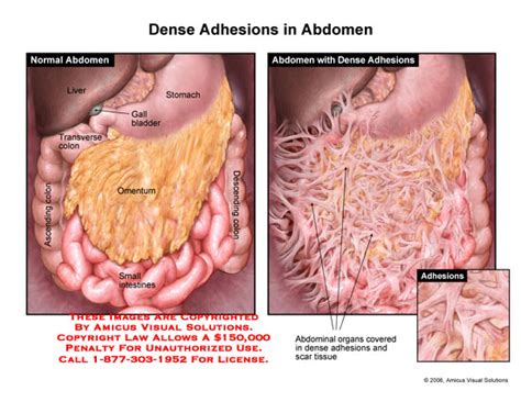 06951 01w Dense Adhesions In Abdomen Anatomy Exhibits