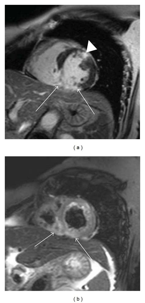 63 Year Old Female With Myocardial Infarction Short Axis Download