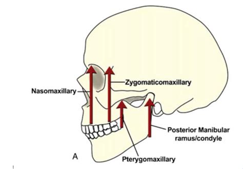 Zygomaxillary Complex Fractures Zmc Flashcards Quizlet