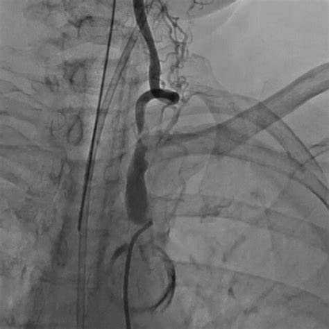 The Left Subclavian Artery Was Occluded Near The Bifurcation Of The Download Scientific Diagram