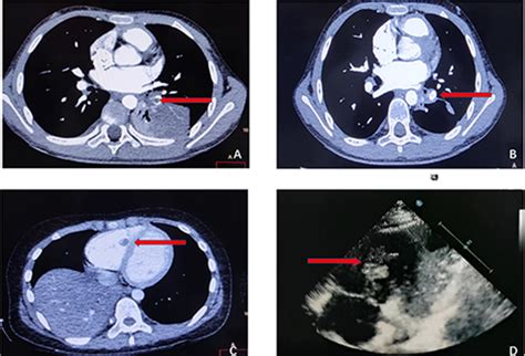 A Ctpa Showed Filling Defects In The Left Pulmonary Artery B Repeat Download Scientific