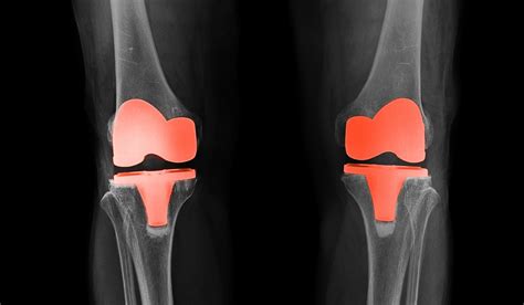 Osteoarthritis Knee Replacement Alternatives